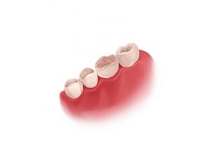 5 Type of Filling - Different Types of Fillings