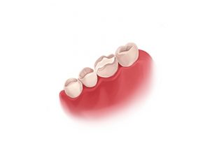 5 Type of Filling - Different Types of Fillings
