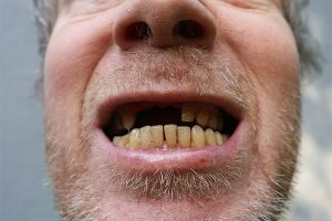 4 Consequences of Missing Teeth, Causes, Treatment, and Options